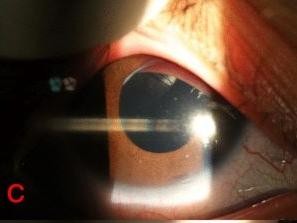 Lens Dislocation | Diagnosis of congenital ectopia lentis: a case ...