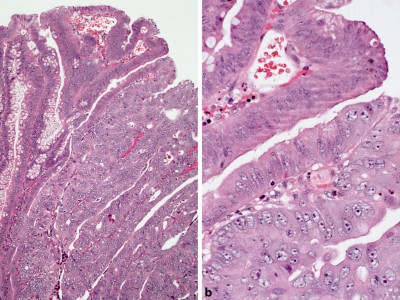 Darmpolypen | Kolonpolypen – Nomenklatur, Histologie und ...