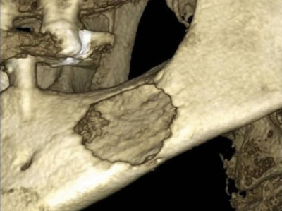 Breast Cancer | Mandibular metastasis of invasive ductal carcinoma of ...