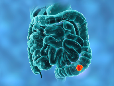 Metastasis | Automatic segmentation-based radiomics and deep learning ...