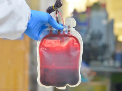 Hämofiltration | High-flux-Dialyse, Hämodiafiltration, High-cut-off ...
