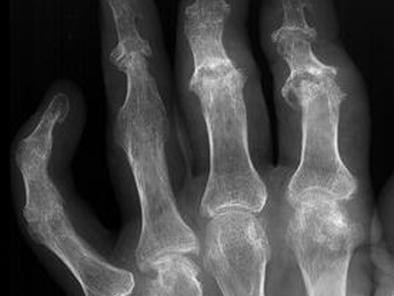 Osteosynthese | Technik und Biomechanik der Bohr-Draht(Kirschner-Draht ...