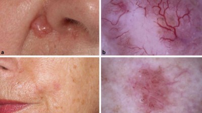 Basalzellkarzinom | Basalzellkarzinom: MAL-PDT vs. Fluorouracil und ...