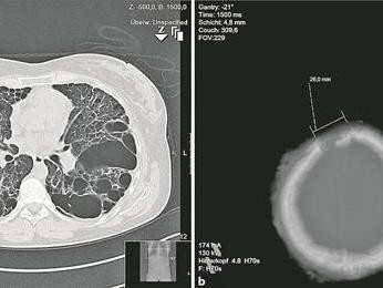 Pusteln am Kopf, Zysten in der Lunge – Syrerin gab Rätsel auf ...