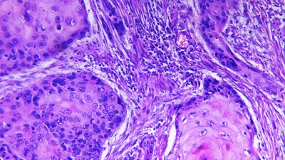 Mundhöhlenkarzinom | Operation ist erste Wahl in der Salvage-Therapie ...