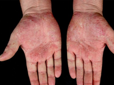 Facharzt-Training Dermatologie | 46/m mit Pusteln an Hand- und ...