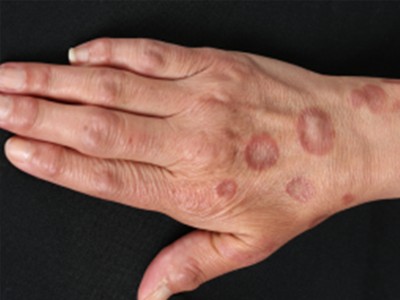 Facharzt-Training Dermatologie | 45/w mit asymptomatischen Papeln und ...