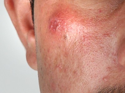 Facharzt-Training Dermatologie | 46/m mit größenprogredientem Nodus im ...