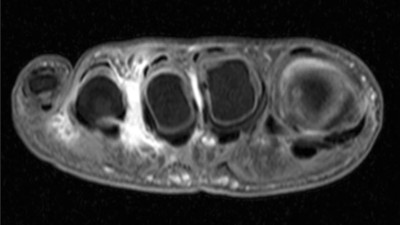 Podotherapie | Relatie tussen fysiek gewrichtsonderzoek en MRI ...