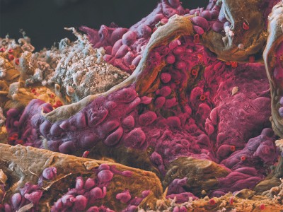 Innere Medizin | CodeBreak-200: Erstmals Phase-III-Daten zu Sotorasib ...