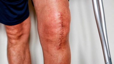 Varusgonarthrose: Osteotomie immer am Ort der Fehlstellung ...