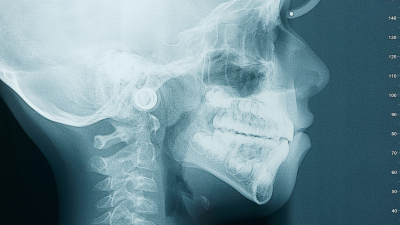 PECARN prediction rule has ‘strong potential’ to guide cervical spine ...