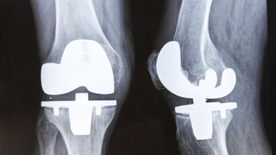 Orthopädie und Unfallchirurgie | Knie-TEP: Mit Patellarückflächen ...