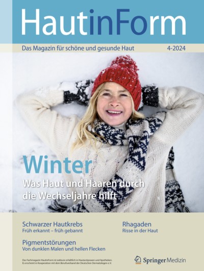 Glucocorticoide | Risse in der Haut | springermedizin.de