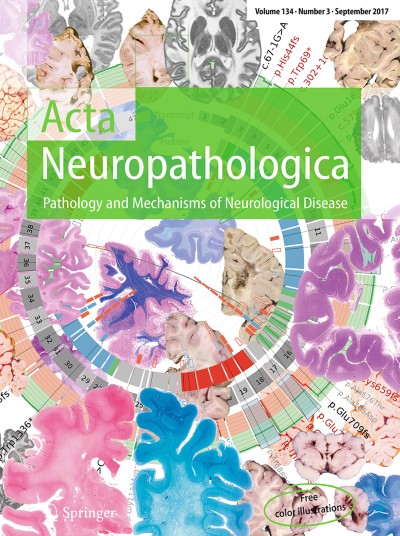 Parietal white matter lesions in Alzheimer’s disease are associated with cortical ...