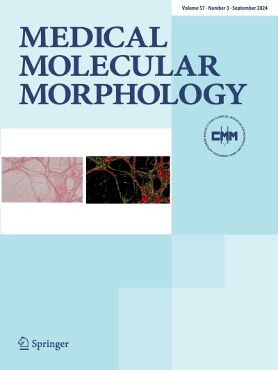 Sarcoma Nf1 Mutation And Tubb3 Amplification In Gastric Histiocytic Sarcoma A Case Report And