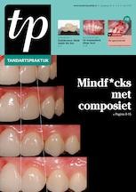 Collum mandibulae-fracturen: open versus gesloten behandeling | mijn-bsl