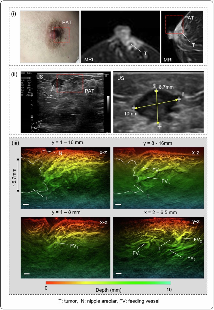 A fast all-optical 3D photoacoustic scanner for clinical vascular ...