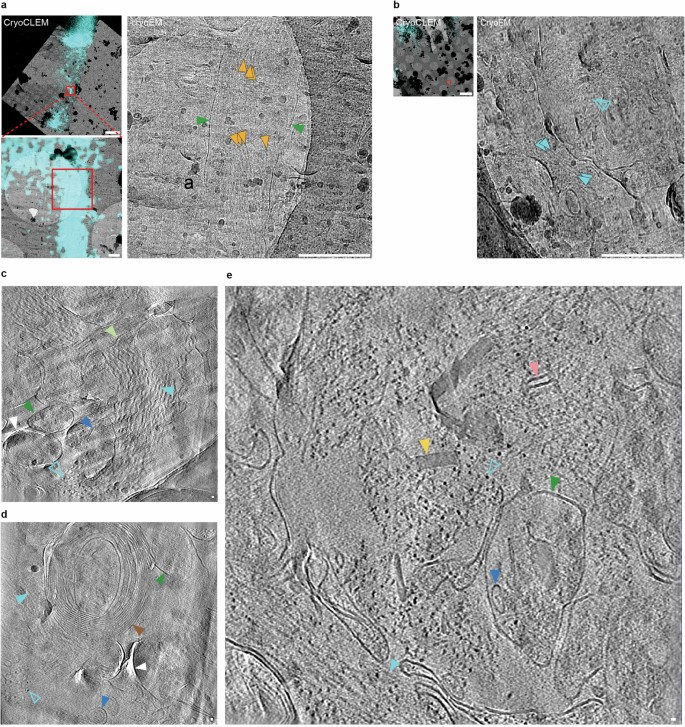 CryoET of β-amyloid and tau within postmortem Alzheimer’s disease brain ...