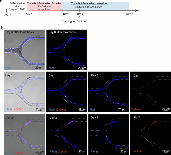 Clinically relevant clot resolution via a thromboinflammation-on-a-chip ...