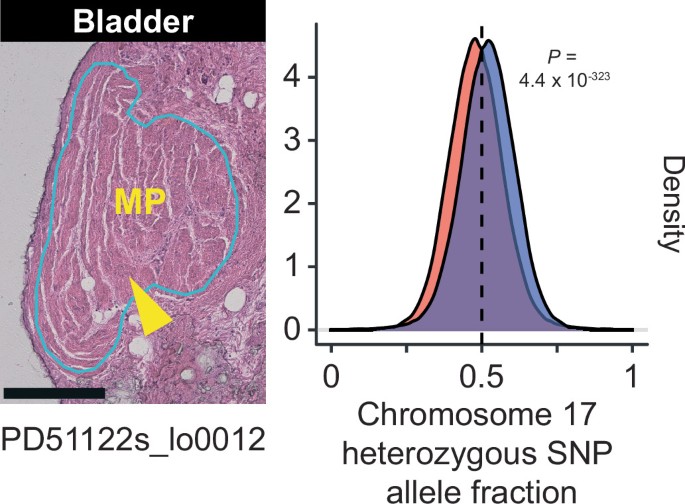Cancer-independent somatic mutation of the wild-type NF1 allele in ...