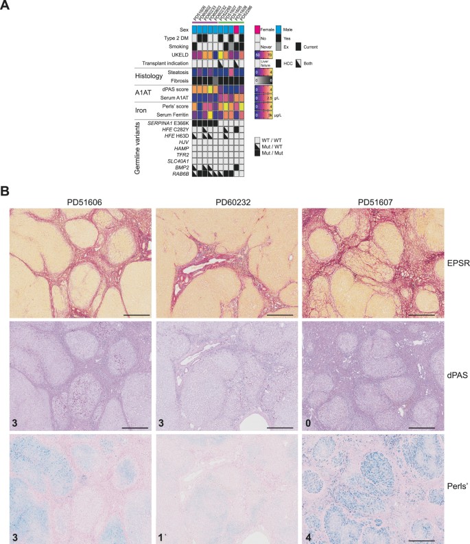 Selection for somatic escape variants in SERPINA1 in the liver of ...