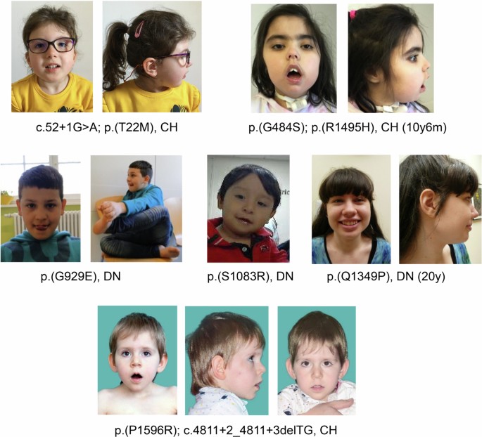 Pathogenic UNC13A variants cause a neurodevelopmental syndrome by ...