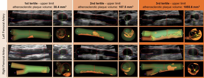 Unidirectional association of clonal hematopoiesis with atherosclerosis ...