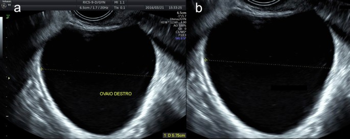 International multicenter validation of AI-driven ultrasound detection ...