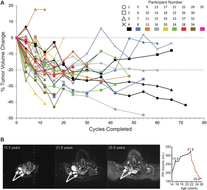Selumetinib in adults with NF1 and inoperable plexiform neurofibroma: a ...