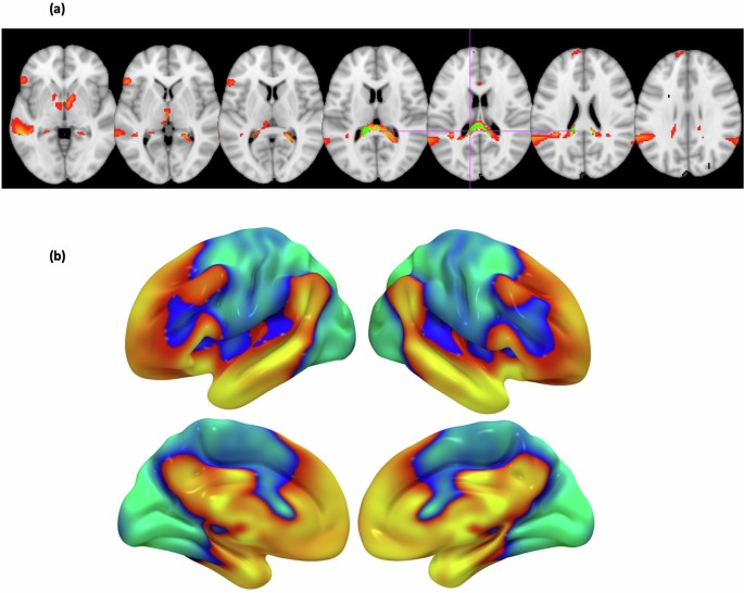 A potential target for noninvasive neuromodulation of PTSD symptoms ...