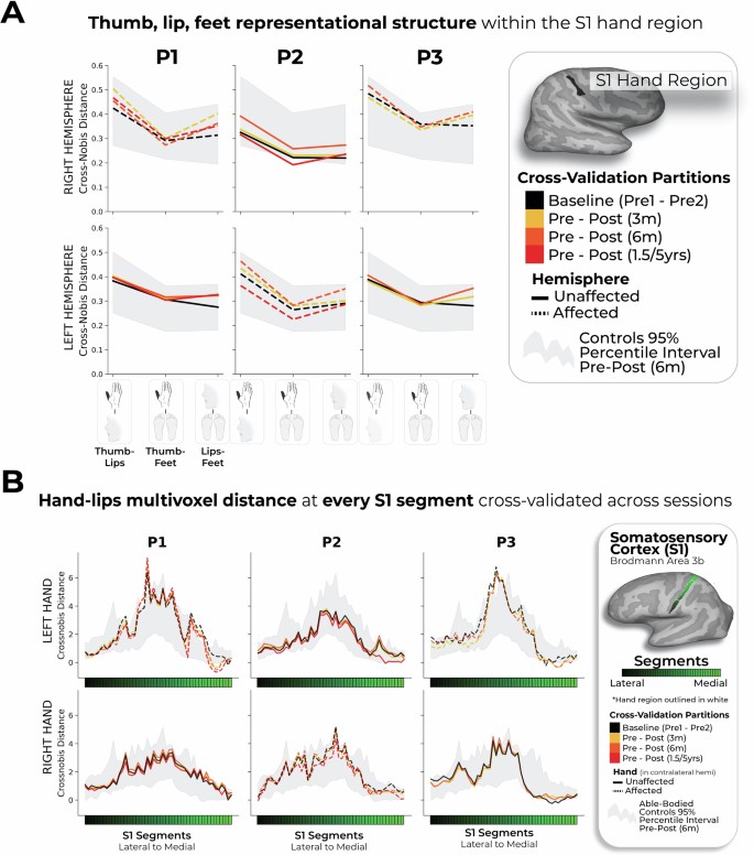 Stable cortical body maps before and after arm amputation | Nature ...