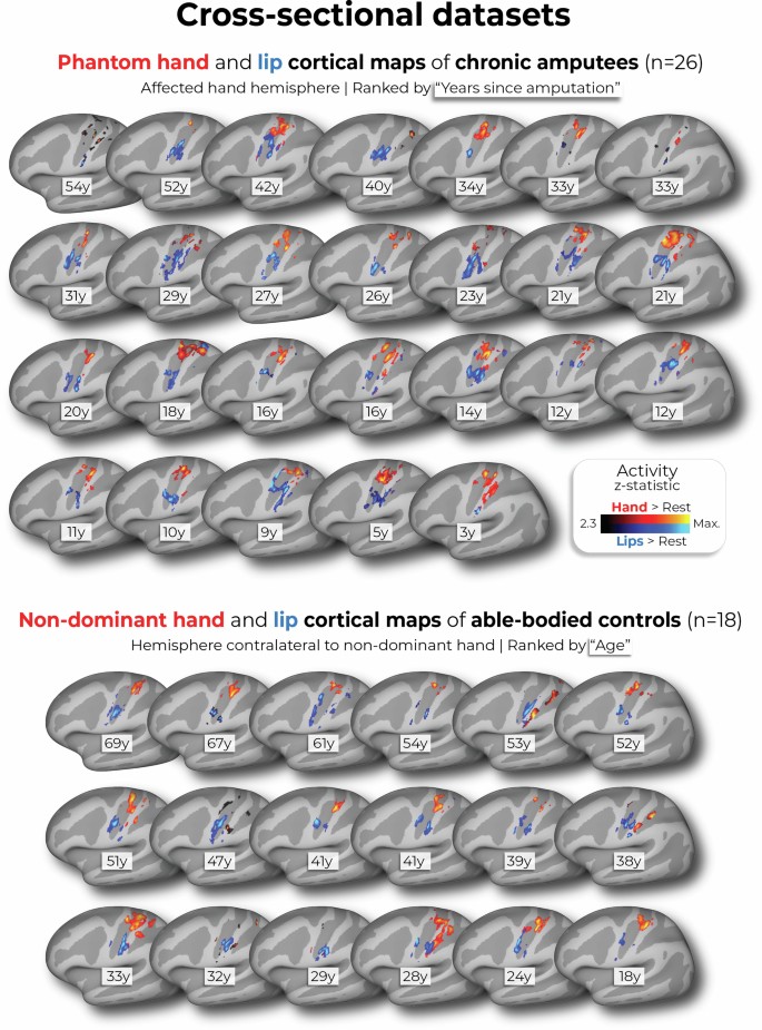 Stable cortical body maps before and after arm amputation | Nature ...