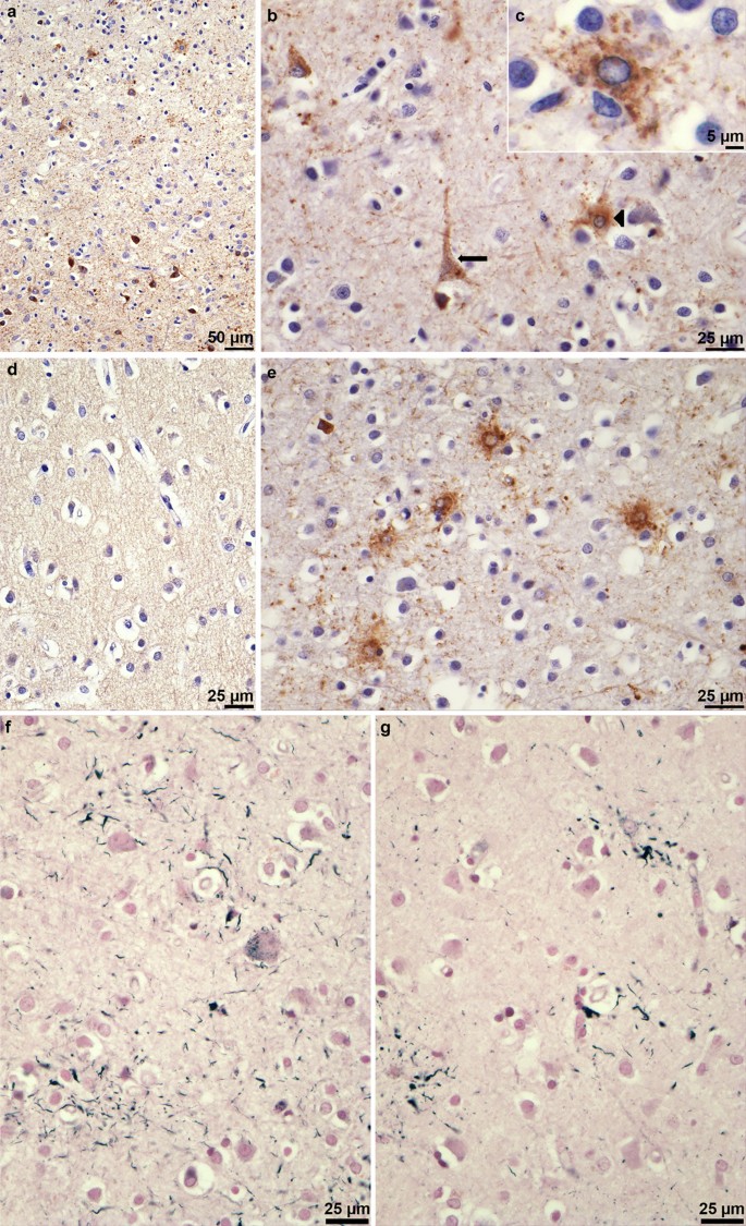 Distinct tau filament folds in human MAPT mutants P301L and P301T ...