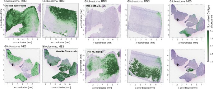 Spatially resolved transcriptomics and graph-based deep learning improve accuracy of routine CNS ...