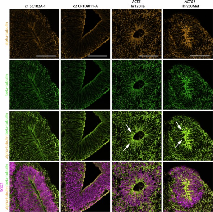 Cerebral organoids expressing mutant actin genes reveal cellular ...