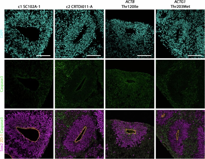 Cerebral organoids expressing mutant actin genes reveal cellular ...