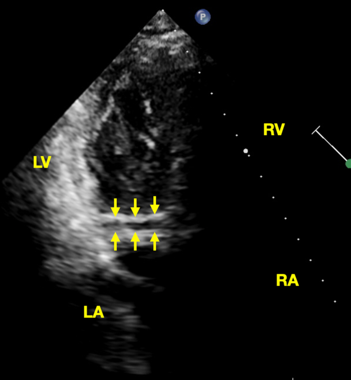 Role of the coronary sinus in risk stratification and prognostic ...