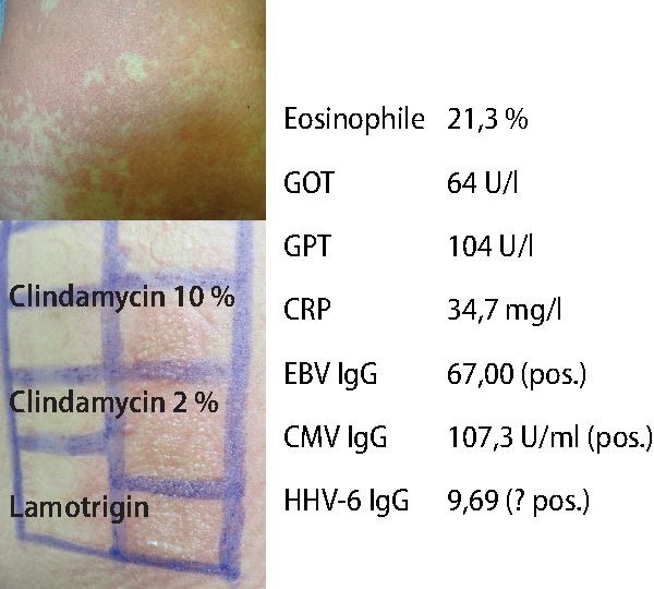 Allergische Arzneimittelreaktionen - ein Update | HNO Nachrichten