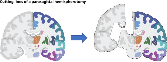 Subacute Degeneration of Fibers After Vertical Parasagittal ...
