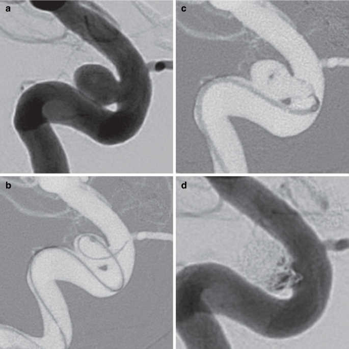Propensity Score-matched Comparison of WEB 17 and WEB 21 with 4–7 mm ...