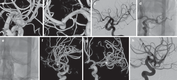 Y Stent-Assisted Coiling Technique for Bifurcation Aneurysms Using ...