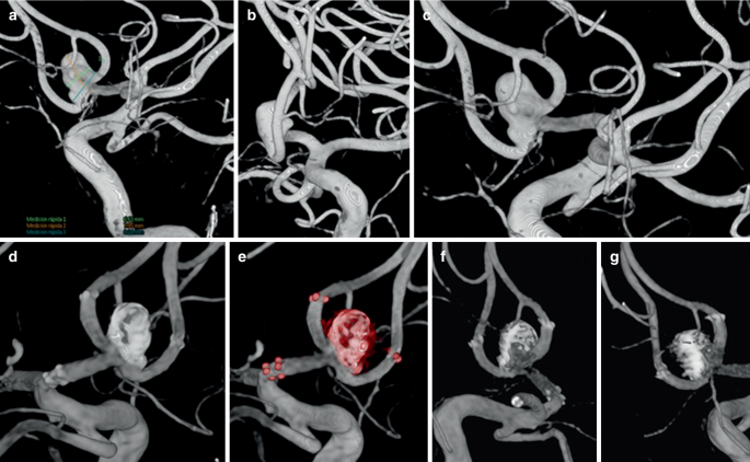 Y Stent-Assisted Coiling Technique for Bifurcation Aneurysms Using ...