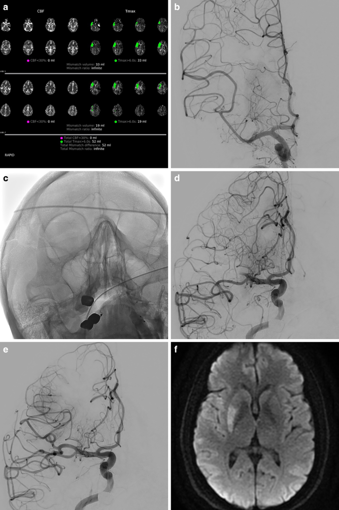 Mechanical Thrombectomy for Middle Cerebral Artery Medium Vessel ...