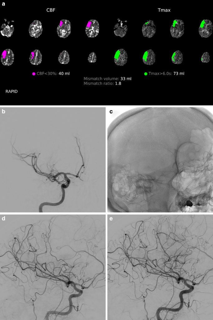 Mechanical Thrombectomy for Middle Cerebral Artery Medium Vessel ...