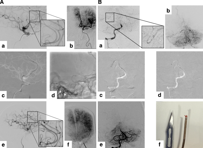 First-line Aspiration Thrombectomy with the RED43 Catheter for Acute ...