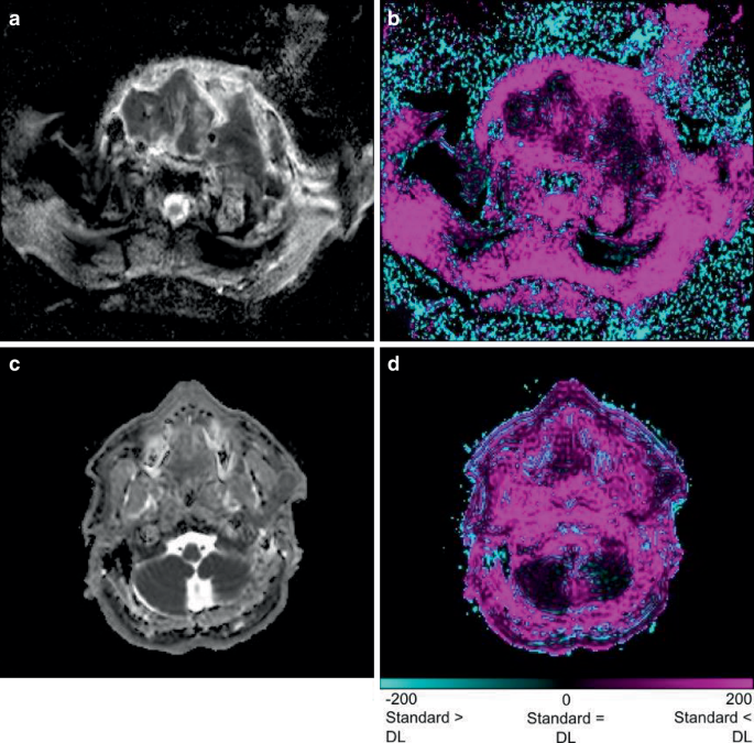 Deep Learning Reconstruction of Diffusion-weighted MRI Enables Shorter ...