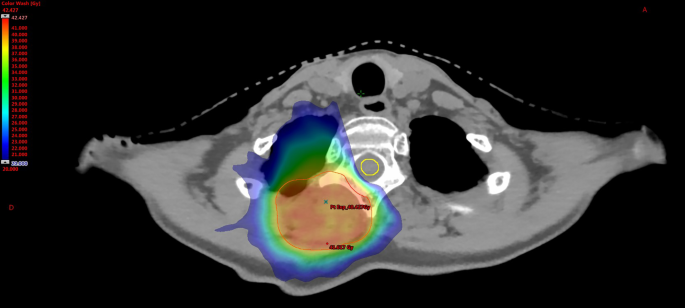 Tolerance of radiotherapy with concomitant glofitamab in diffuse large ...