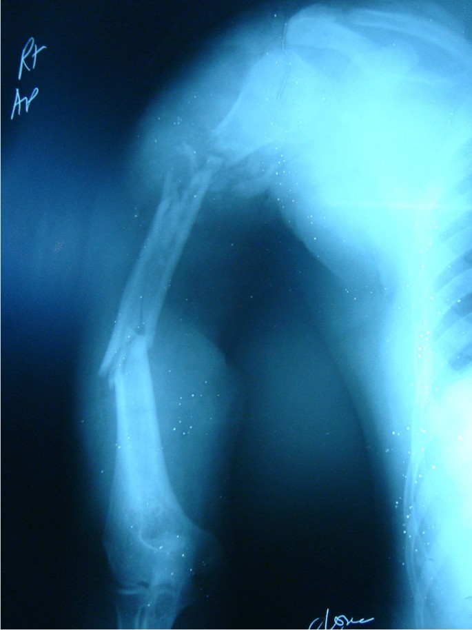 Assault rifle injuries in civilians: ballistics of wound patterns ...