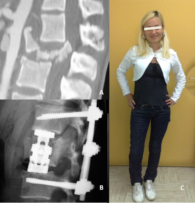 Thoracolumbar spinal cord injury: management, techniques, timing ...